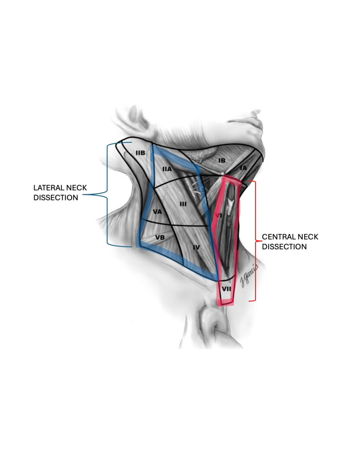 Lateral Neck Dissection: What You Should Know